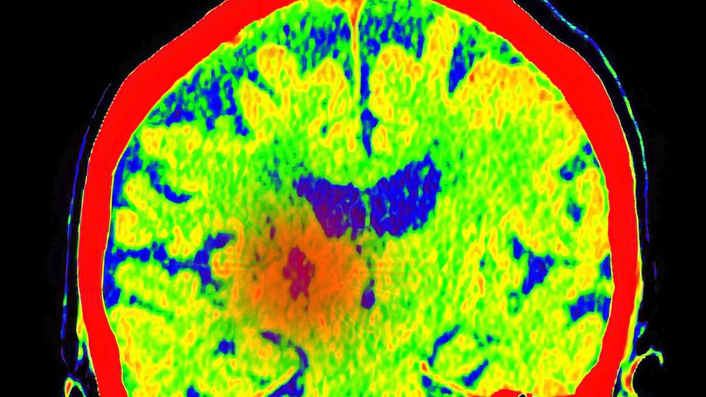 How the Scars of Demolished Brain Tumors Seed Relapse - - Global ...