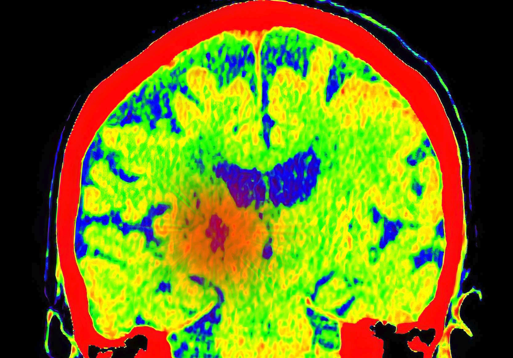 How the Scars of Demolished Brain Tumors Seed Relapse - - Global ...